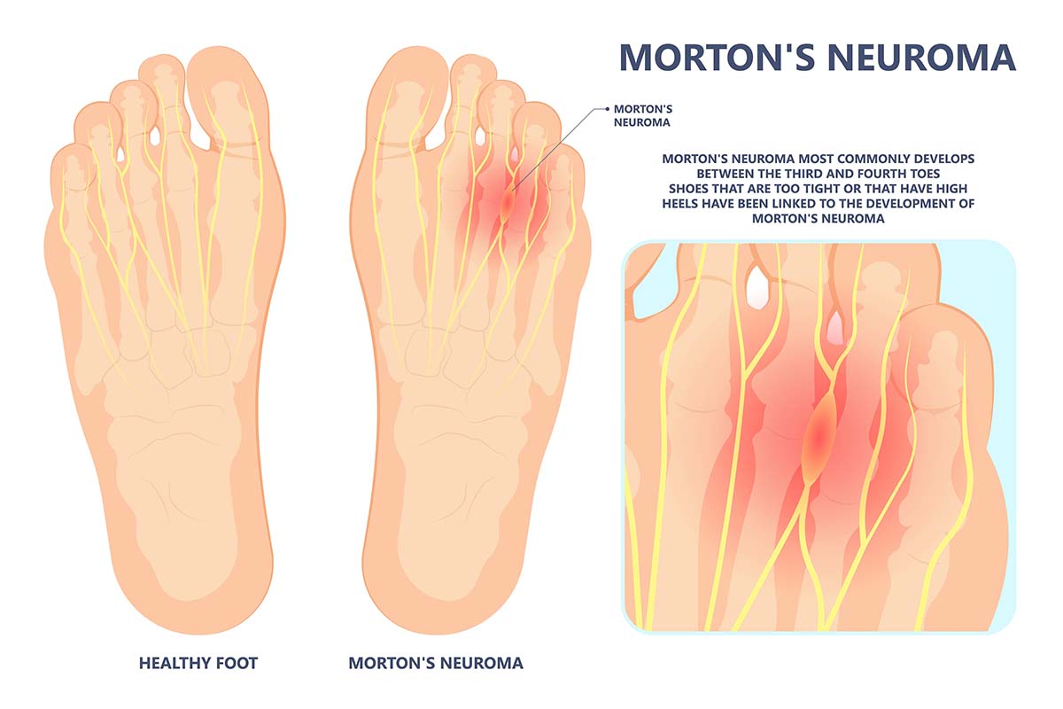 Morton Neurom | Behandlung beim Orthopäden aus 1190 Wien